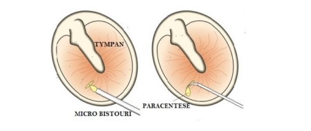 Paracentèse Chirurgie ORL Enfant Nantes - Dr Christophe GRIFON