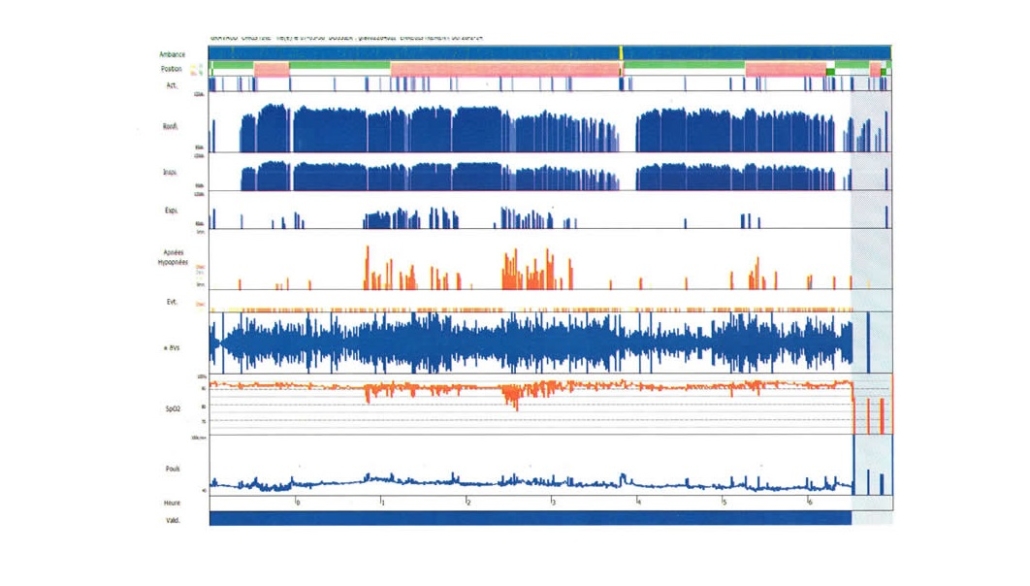 Enregistrement du Sommeil à Nantes - Docteur Christophe GRIFON